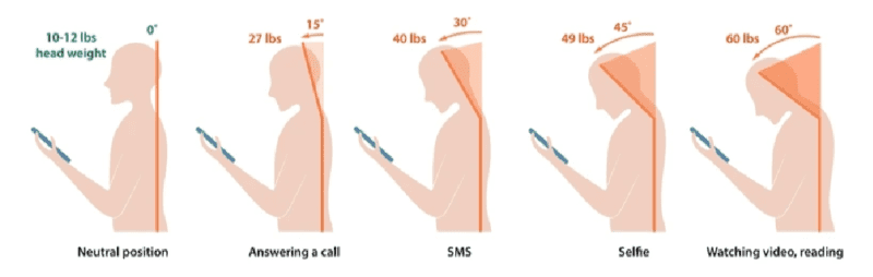 Patients Ask: What is Text Neck Syndrome?